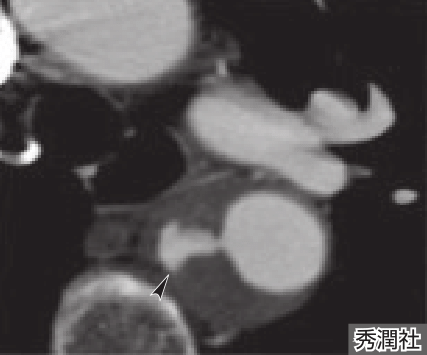 心臓・血管：Intramural blood pools：IBPs | 医療ナレッジ | MSD Connect