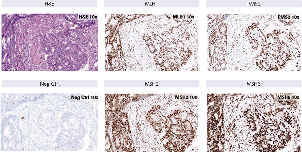 MSI検査/MMR IHC検査とは | MSI検査 | MSD Connect