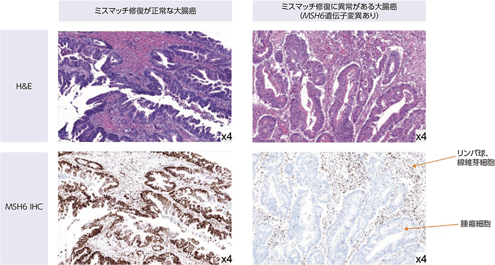 MSI-High固形癌及びMSI-High結腸・直腸癌：MSI検査/MMR IHC検査 | MSD Connect