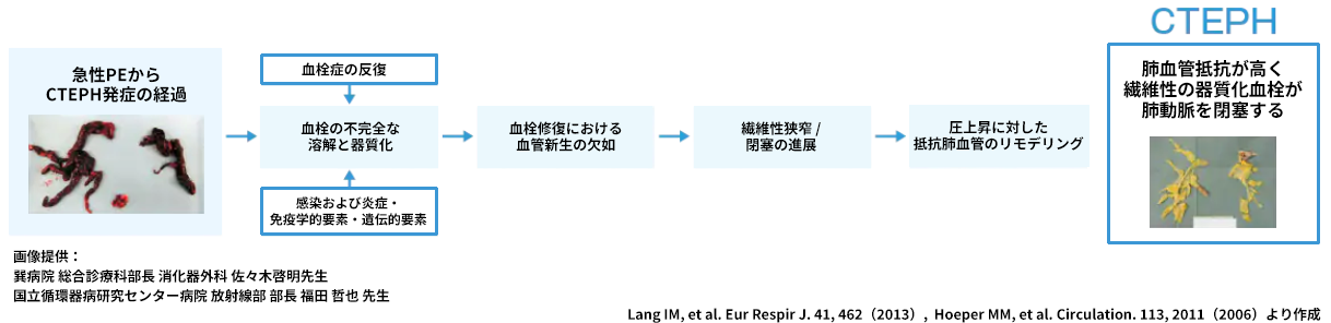 CTEPHの概要 | MSD Connect