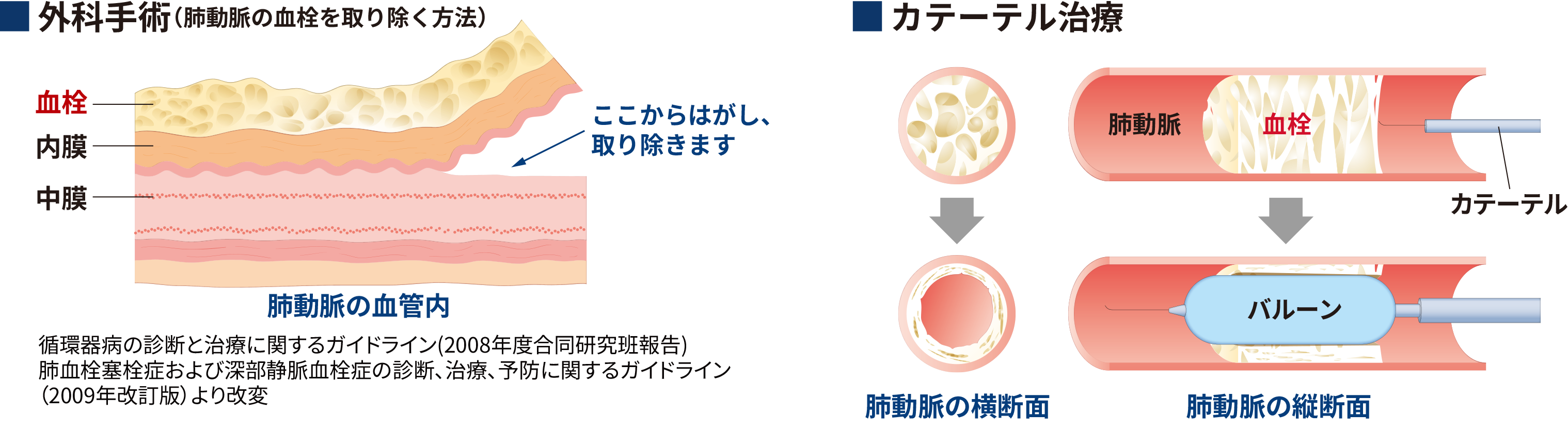 CTEPH （慢性血栓塞栓性肺高血圧症） | MSD Connect