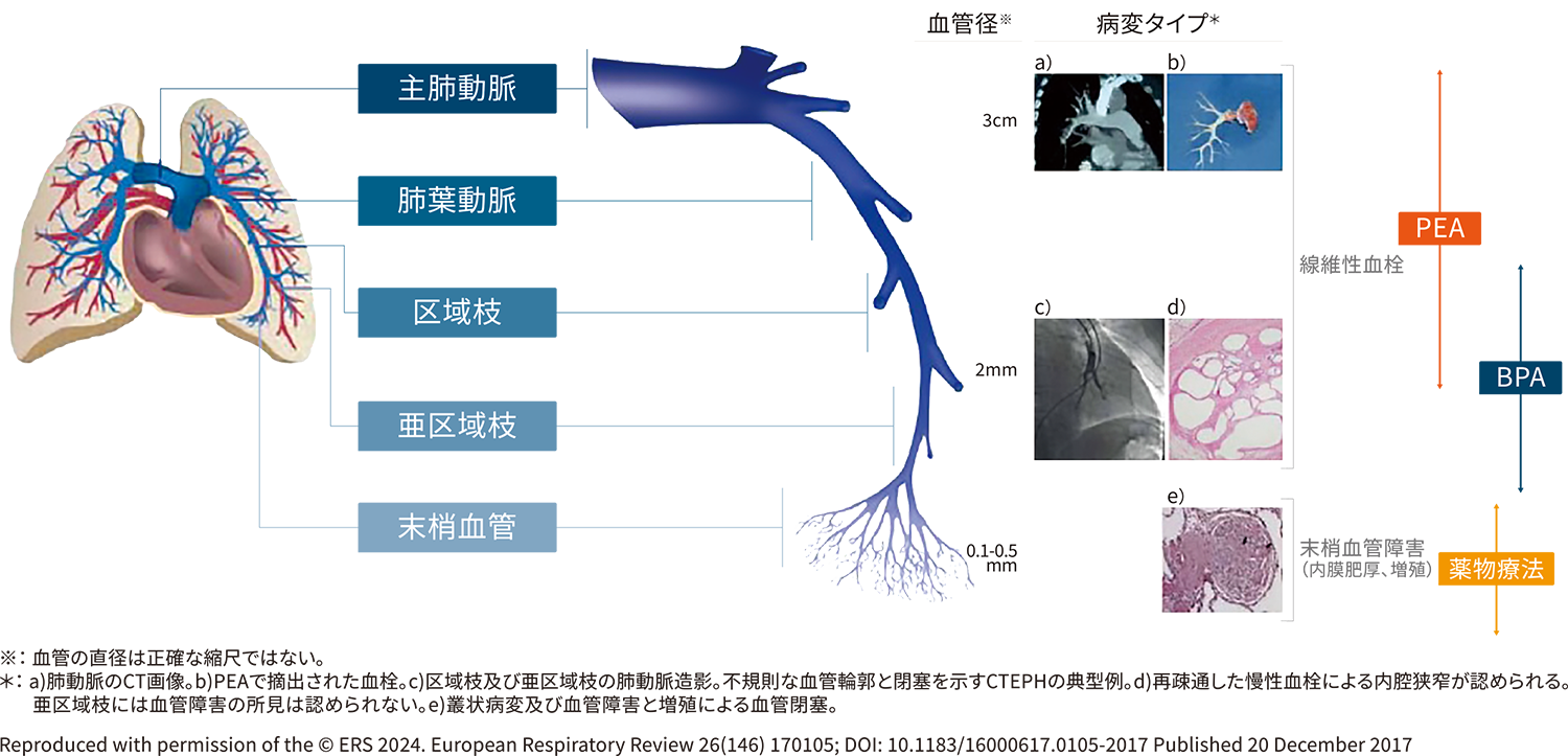 CTEPHの治療アルゴリズム | MSD Connect