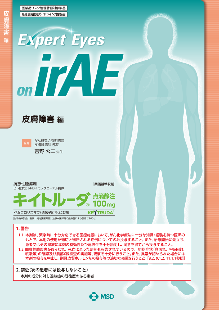 Expert Eyes on irAE | irAE対策・診療サポート | MSD Connect